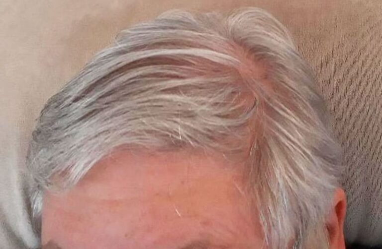 Female Hair Loss - Not So Pretty In Pink - Best Hair Transplant