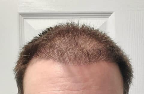 What Does 100 Hairs Look Like - Best Hair Transplant