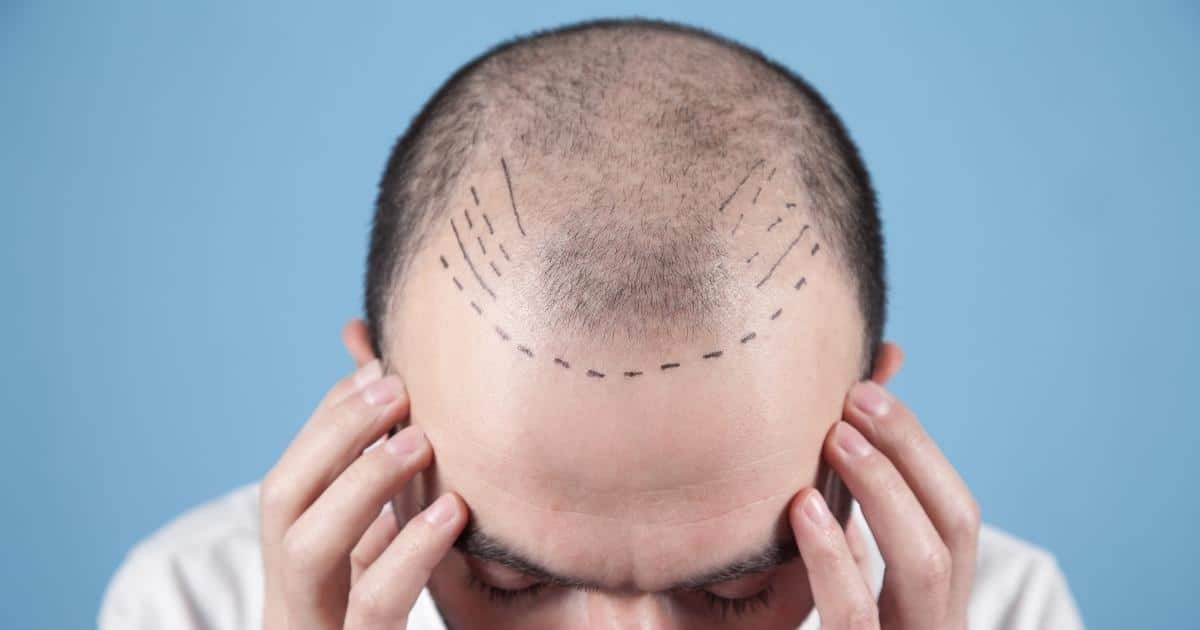 Solve Diffuse Thinning with FUE Hair Transplant Surgery!