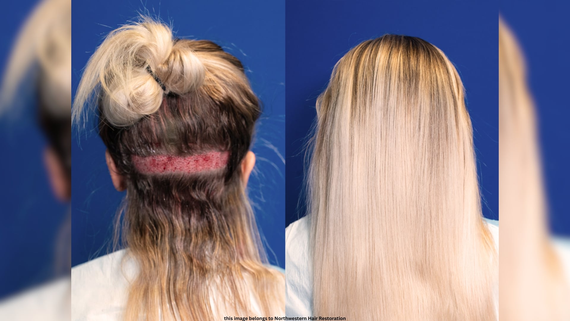 Shaveless FUE: The Best Way to Restore Hair Without Shaving Your Head